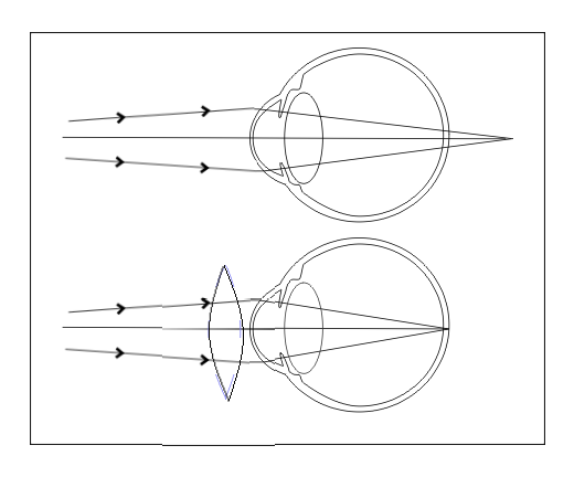 Vision Disorders | Secondaire | Alloprof