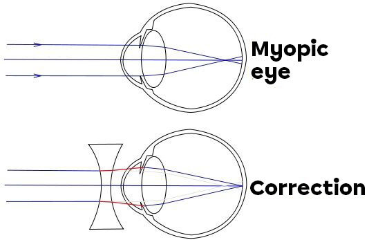 Eye Defects Related to Lens | Secondaire | Alloprof